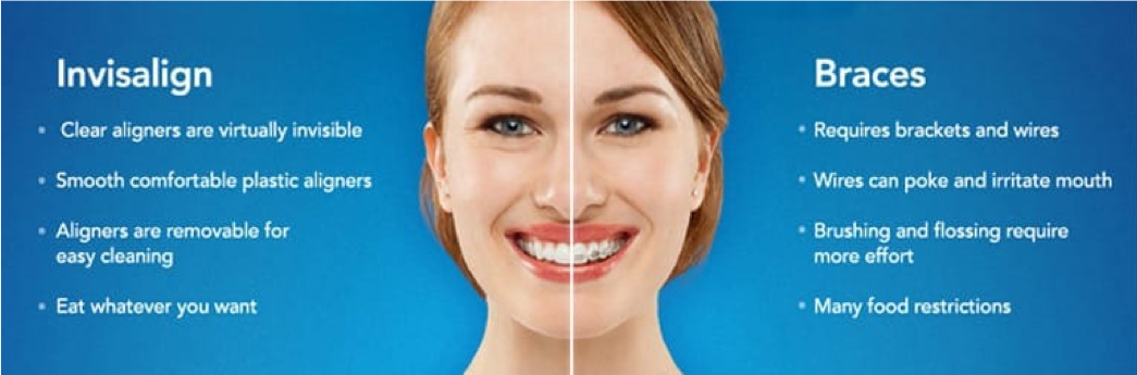 invisalign - Beverly Wilshire Dental